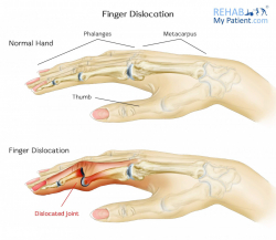 Hand/Fingers/Thumb articles | Rehab My Patient