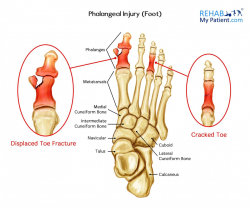 Toe articles | Rehab My Patient