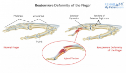 Hand/Fingers/Thumb articles | Rehab My Patient